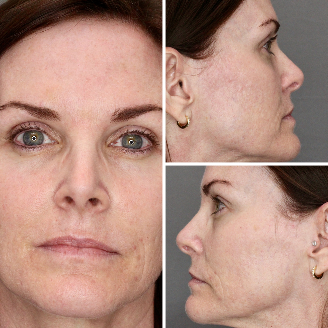 CO2 Laser Q and A with a Patient in her 40s - Ada West Dermatology