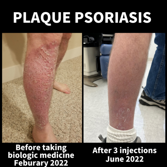 Life changing relief from biologics for our patient with plaque ...